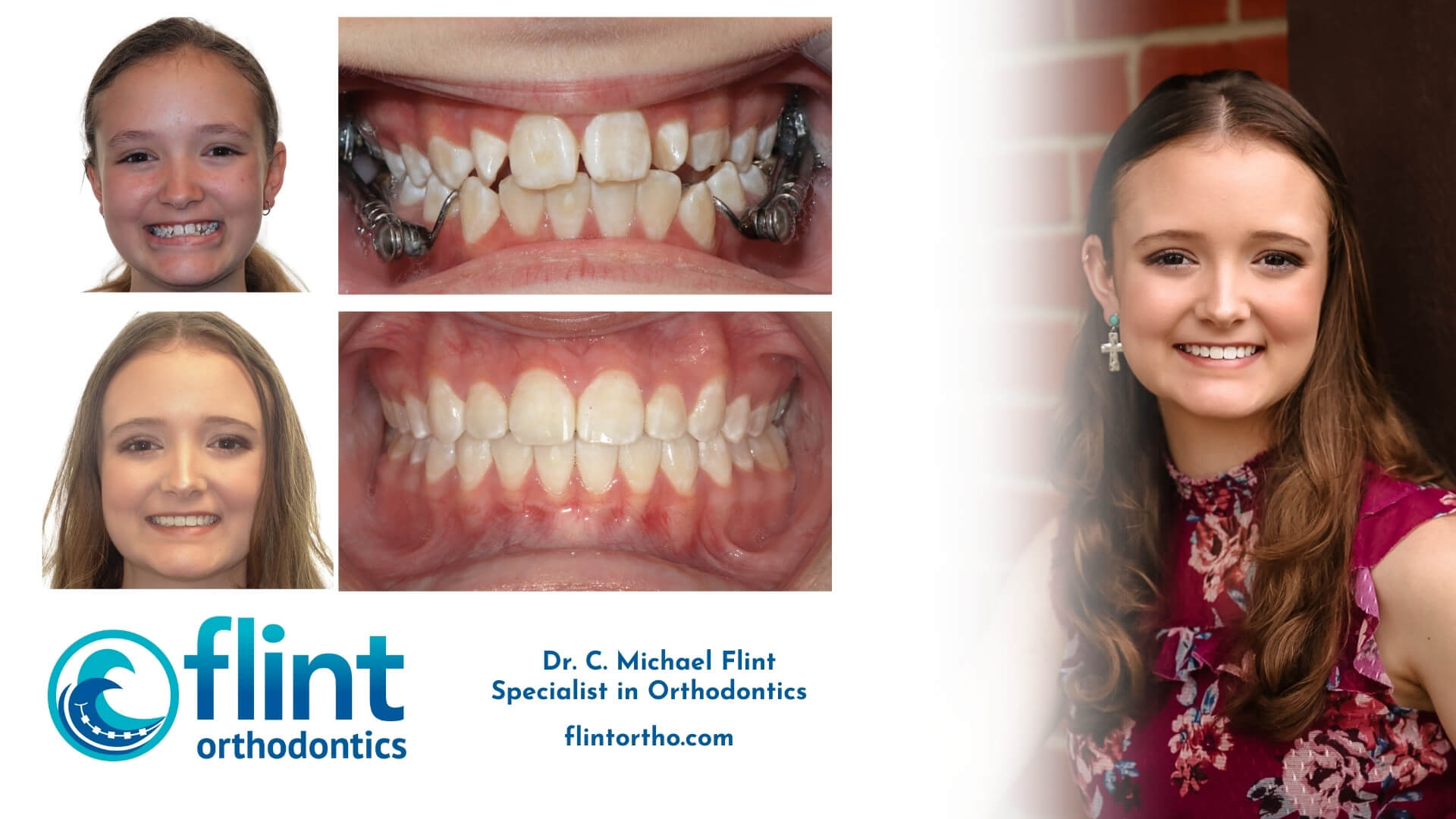 Kilgore Orthodontist | Henderson Orthodontist | Longview | Tyler ...